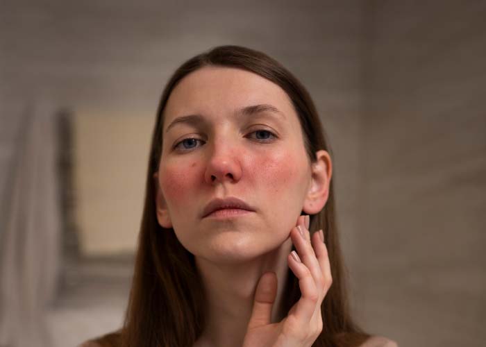 Láser Rosácea - Vitatherapy